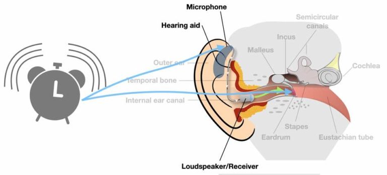 Hearing Aid vs Cochlear Implant – What Is the Difference ...