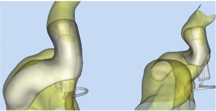 Which Hearing Aid Fits a Small Ear Canal? – improvehearingaids.com